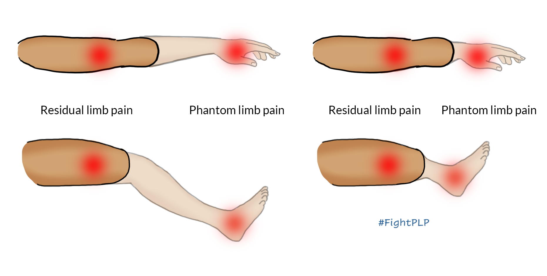 What is Phantom Limb Pain (PLP)?